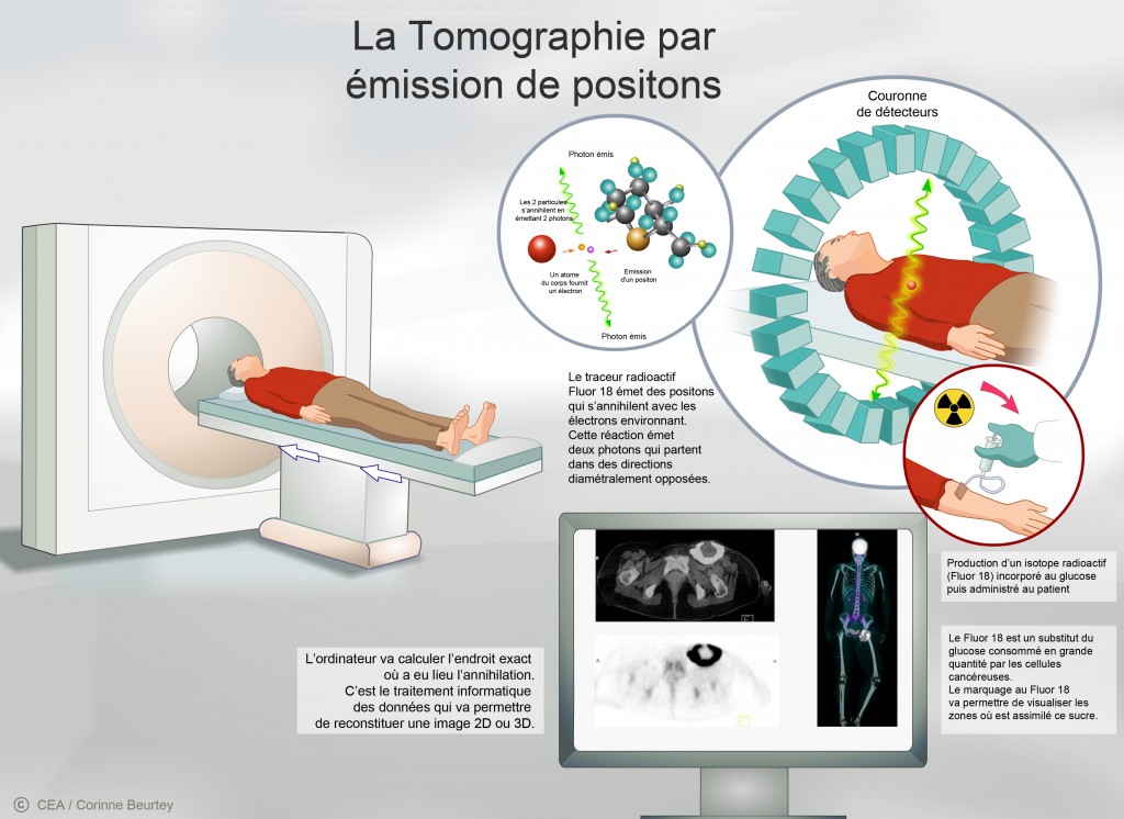 Schema - TEP - Les Cèdres - Centre de Médecine Nuclaire